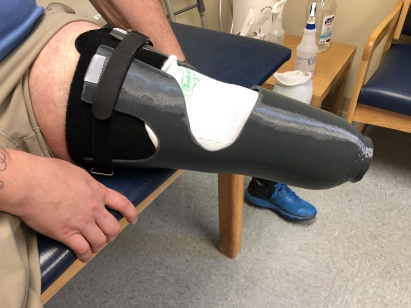 Immediate Post Operative Prosthesis - Abilities In Motion