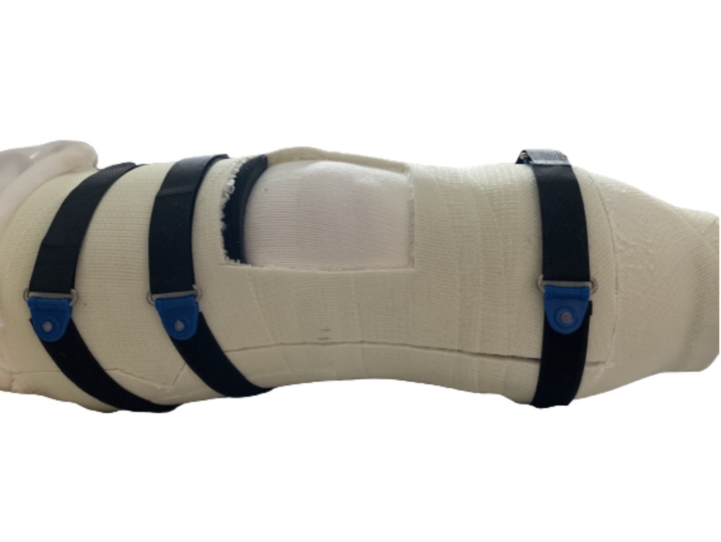 Immediate Post Operative Prosthesis - Abilities In Motion